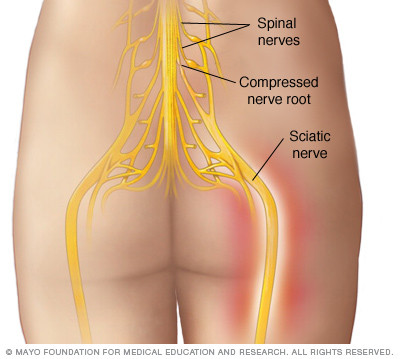 acupuncture for sciatica