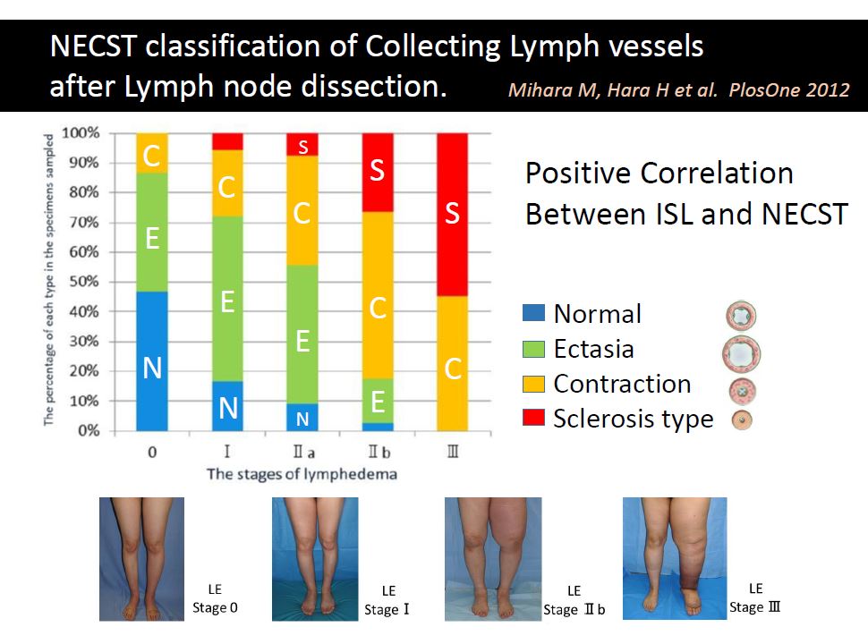 Lymphedema Cases - Lymphedema Surgery Japan, Dr.Mihara (Male) ＆ Dr ...
