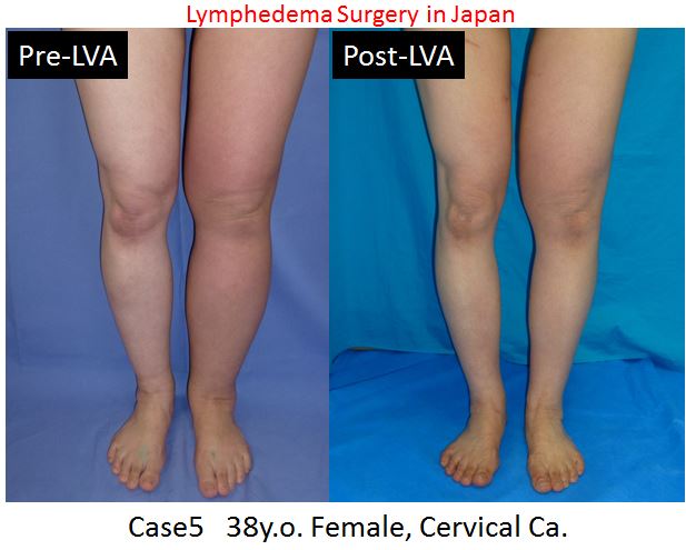 Lymphedema Surgery Japan, Dr. Mihara (Male) ＆ Dr. Hara (Female ...