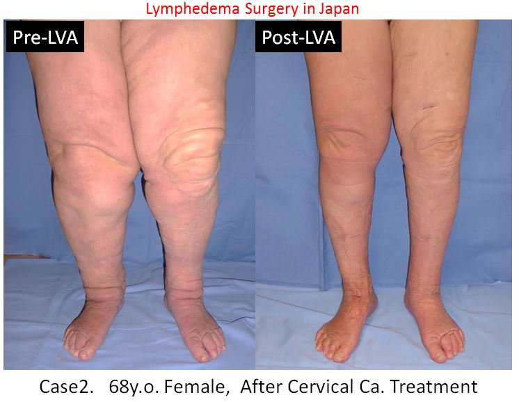 Lymphedema Surgery Japan, Dr. Mihara (Male) ＆ Dr. Hara (Female ...