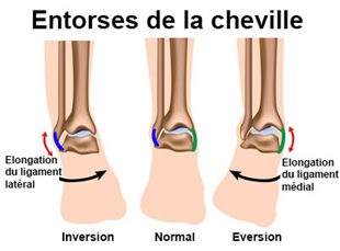 Traumatologie de la cheville: Entorse - Préparateur physique à Bourges ...