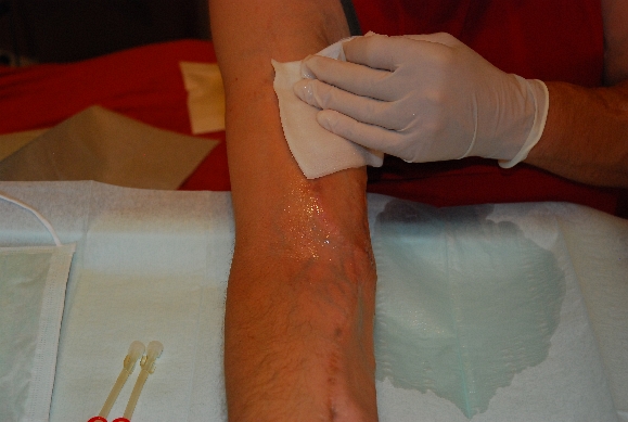 Punktion eines PTFE Shunts - Spektrum Dialyse – Wissen, Hilfe & Infos ...