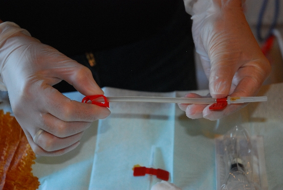 Punktion eines PTFE Shunts - Spektrum Dialyse – Wissen, Hilfe & Infos ...