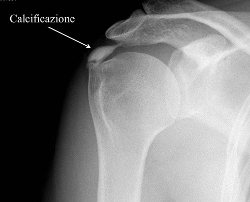 Spalla calcifica - Terapia ad onde d'urto