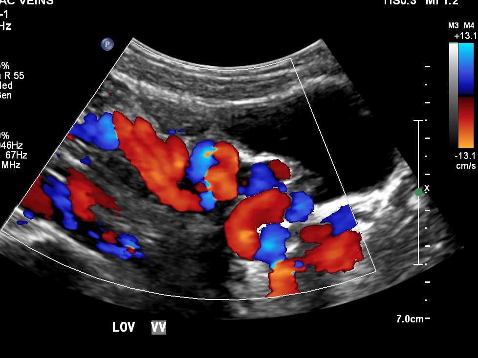 Dedicated to Venous Reflux Testing - Truffles Vein Specialists