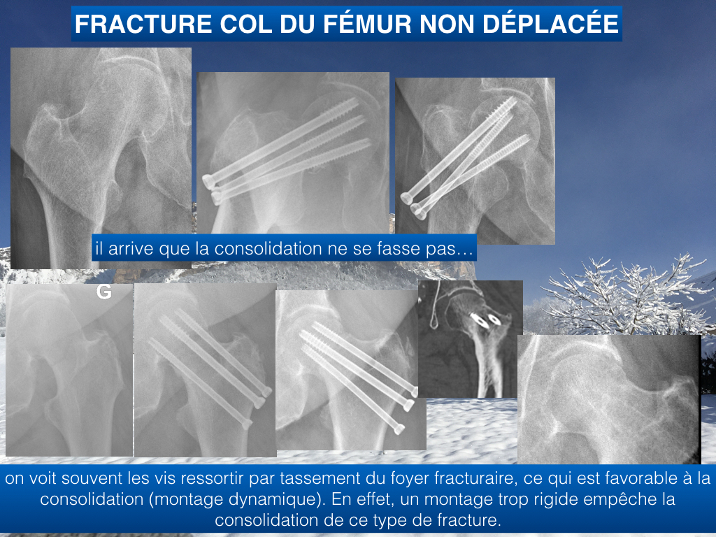 Fracture de hanche du sujet âgé - Dr Rémi : chirurgien orthopédiste à ...
