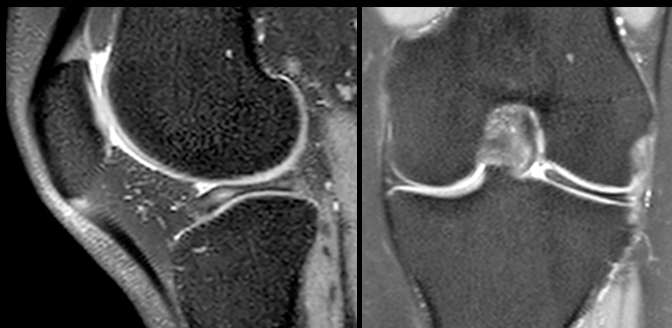 LESION MENISCALE - Dr Rémi : chirurgien orthopédiste à Toulouse