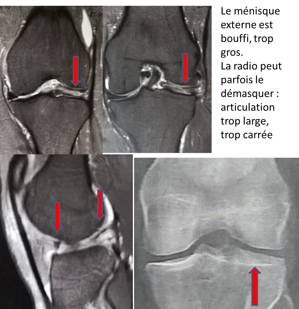 LESION MENISCALE - Dr Rémi : chirurgien orthopédiste à Toulouse