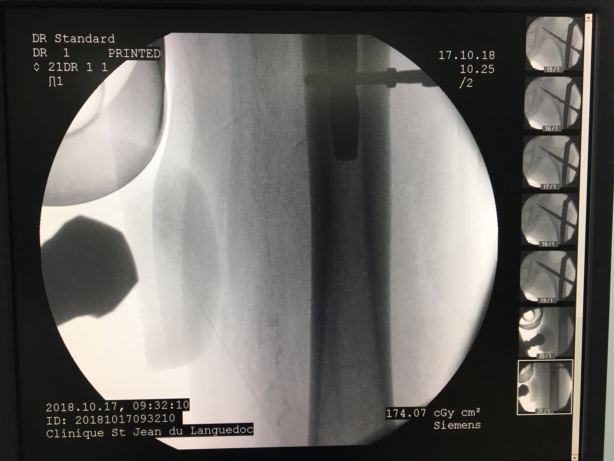 FRACTURE DE HANCHE : RÉPARATION - Dr Rémi : chirurgien orthopédiste à ...