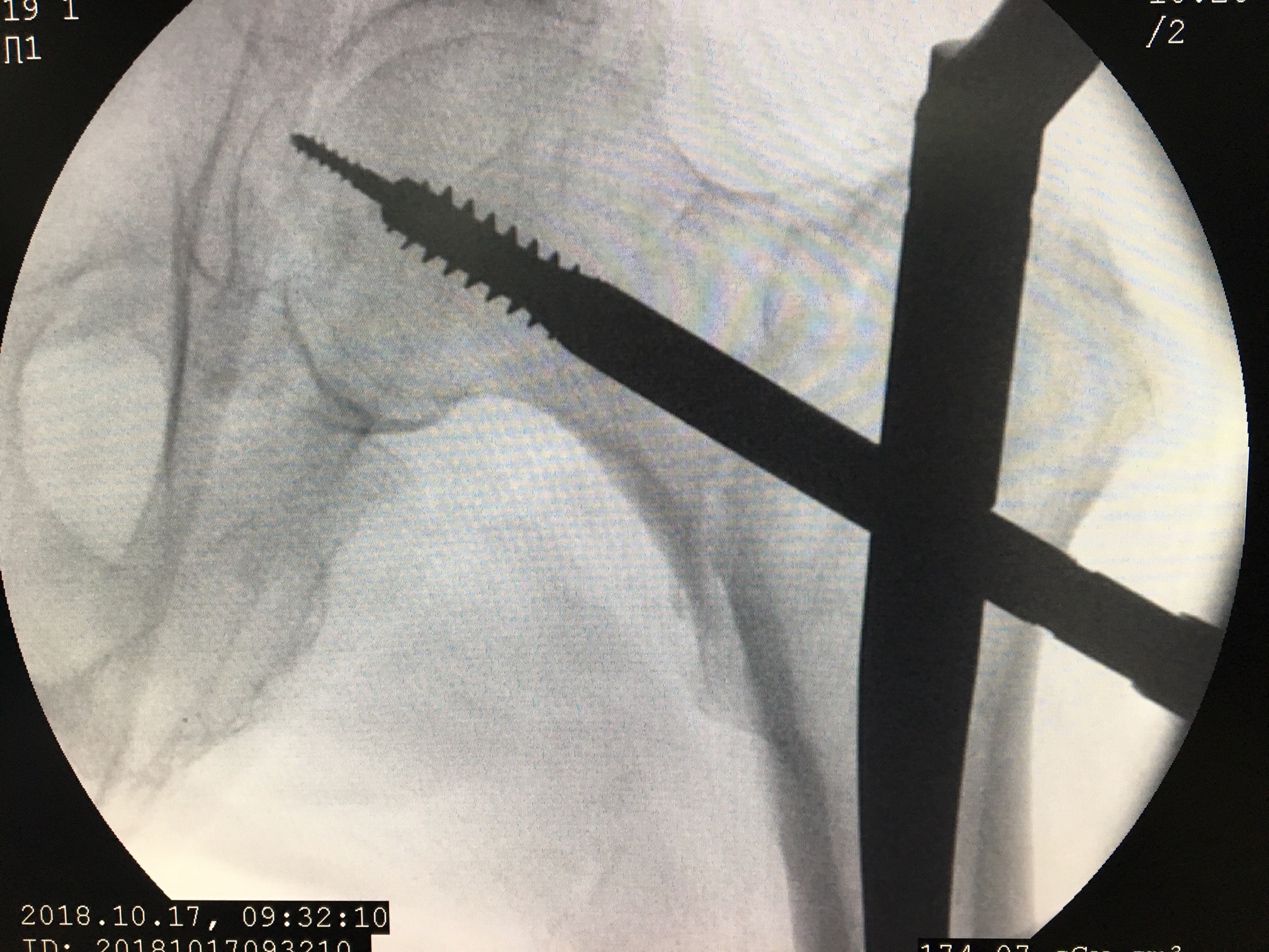FRACTURE DE HANCHE : RÉPARATION - Dr Rémi : chirurgien orthopédiste à ...