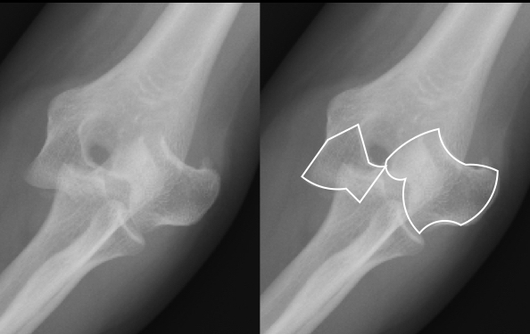 FRACTURE DU COUDE - Dr Rémi : chirurgien orthopédiste à Toulouse