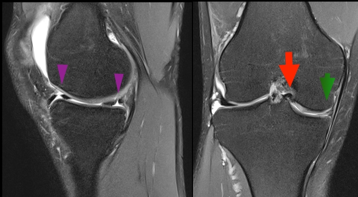 LESION MENISCALE - Dr Rémi : chirurgien orthopédiste à Toulouse