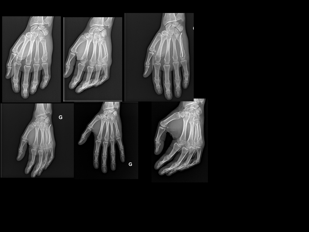 FRACTURE MAIN - Dr Rémi : chirurgien orthopédiste à Toulouse