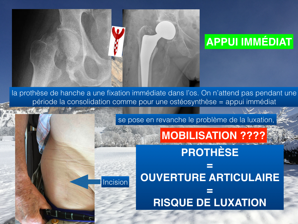 Fracture de hanche du sujet âgé - Dr Rémi : chirurgien orthopédiste à ...