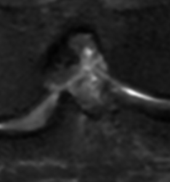 IRM de rupture du LCA - Dr Rémi : chirurgien orthopédiste à Toulouse
