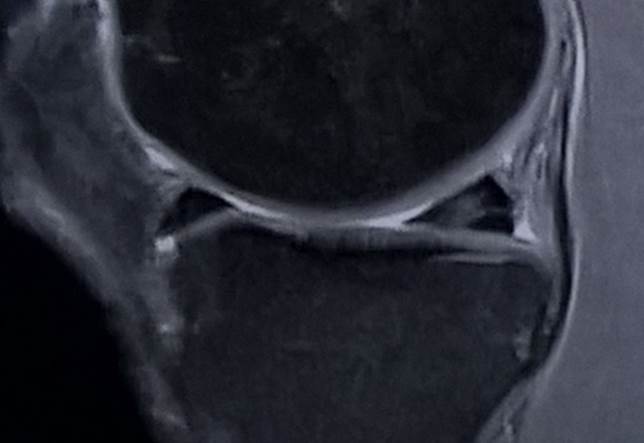 LESION MENISCALE - Dr Rémi : chirurgien orthopédiste à Toulouse