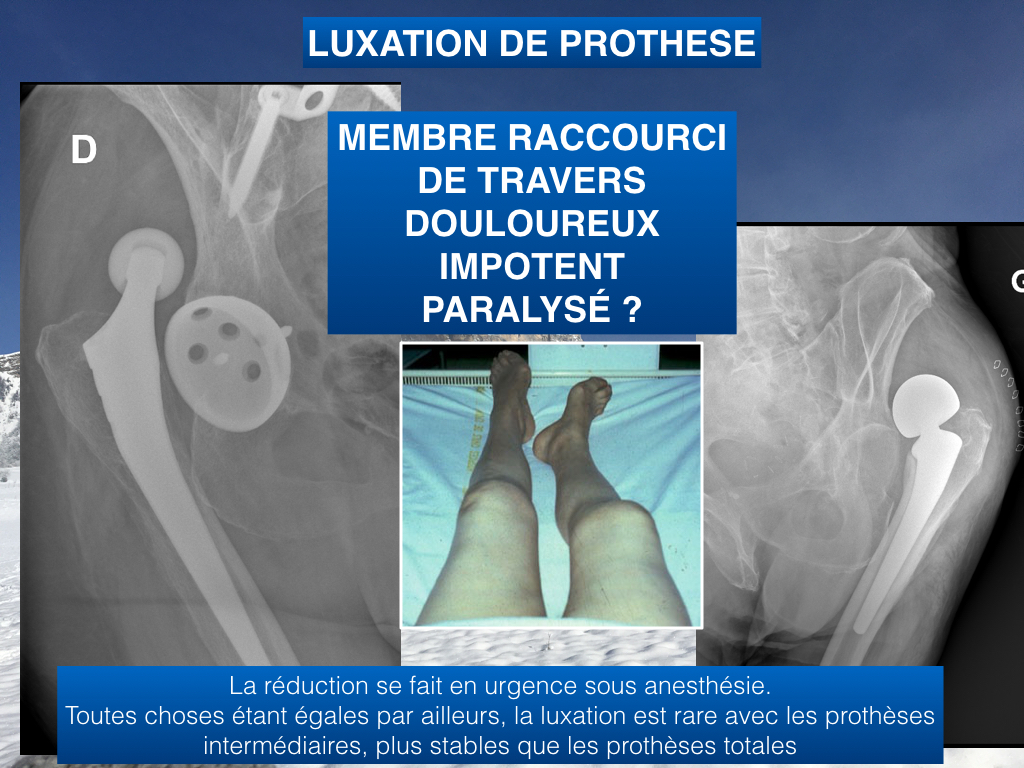 Fracture de hanche du sujet âgé - Dr Rémi : chirurgien orthopédiste à ...