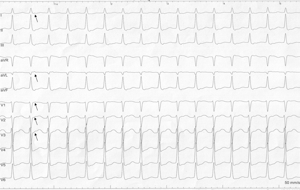AV-Knoten-Reentry-Tachykardie - Fokus-EKG
