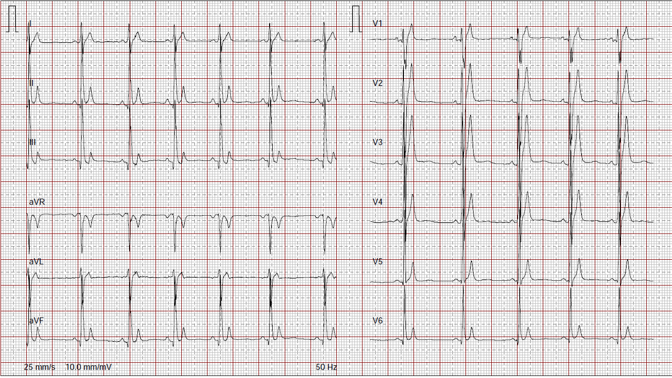 Short-QT-Syndrom - Fokus-EKG