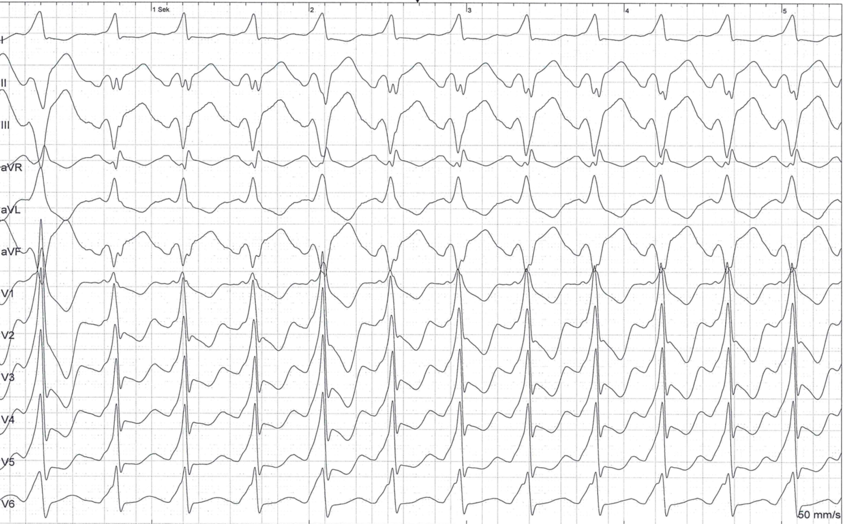 AV-Reentry-Tachykardie und ventrikuläre Präexzitation (WPW-Syndrom ...