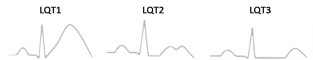 Long-QT-Syndrom - Fokus-EKG
