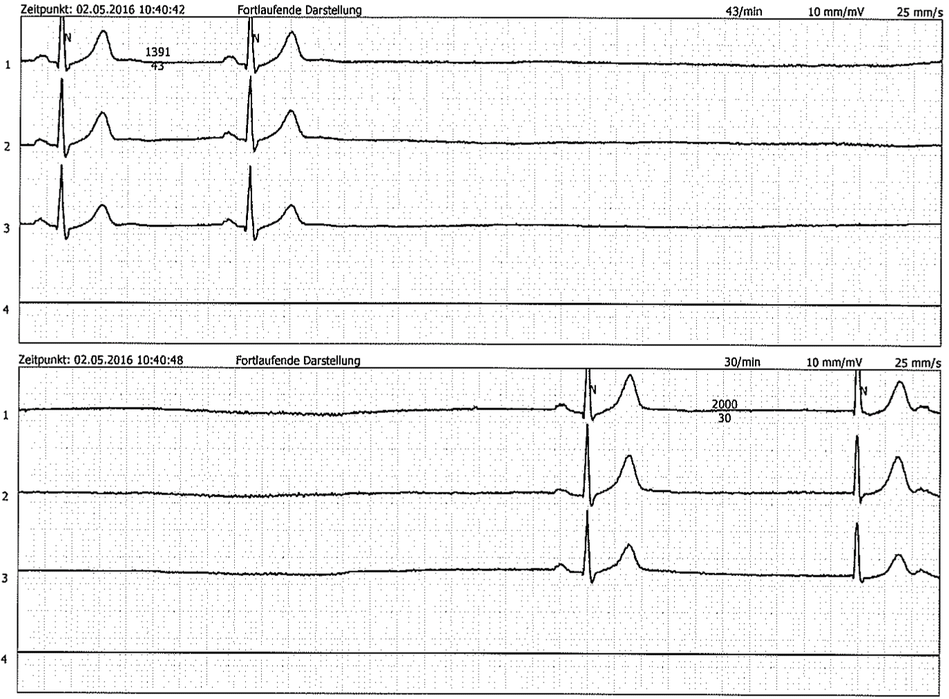 Sinusknotenarrest - Fokus-EKG