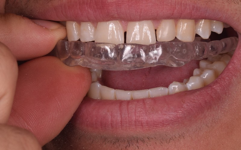 Aufbissschienen und Schnarcherschienen - DentalTeam Goller