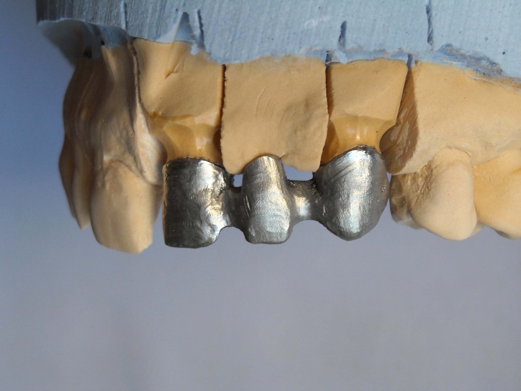 Protesi - Studio dentistico dr. Marcello Fantini - Lanciano