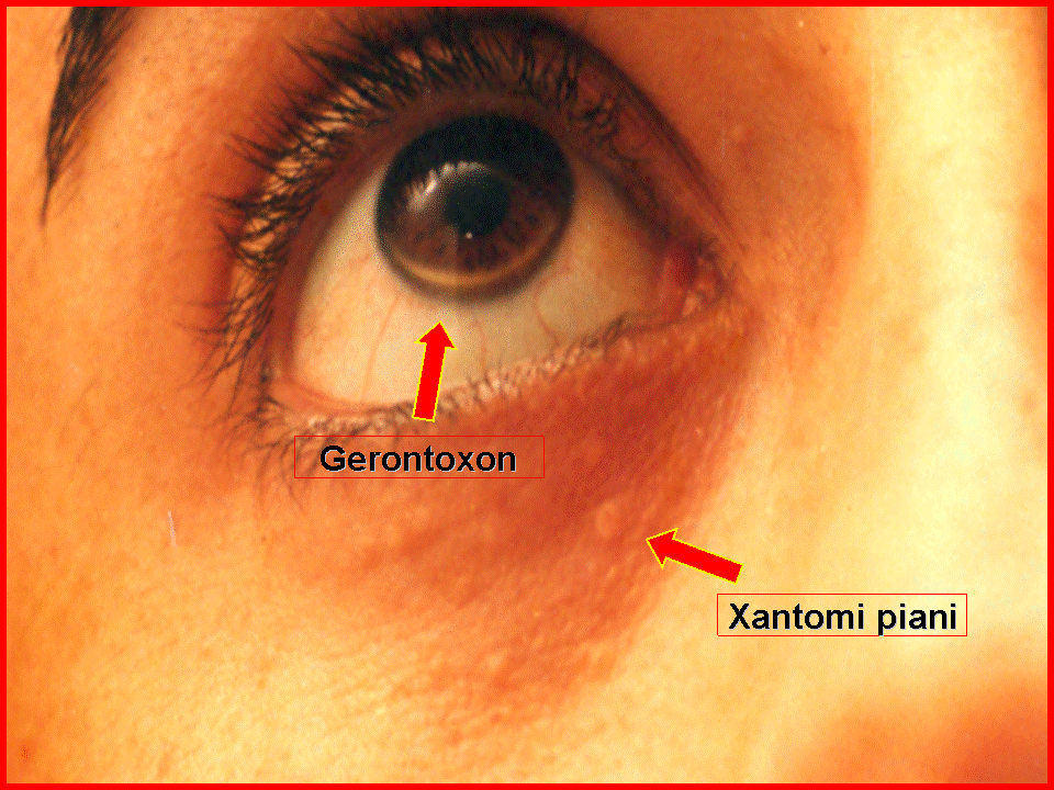 -Ipercolesterolemia - gennarino borrello