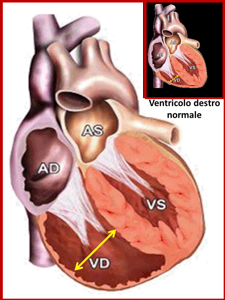 -La displasia aritmogena del ventricolo destro - gennarino borrello