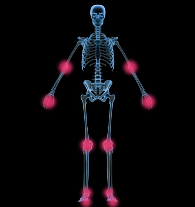 Der akute Gichtanfall - GichtInfo.de
