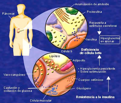 CELULAS BETA - MI DIABETES