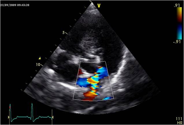 Persistierender Ductus Arteriosus Botalli (PDA) - kardiokonsults jimdo ...