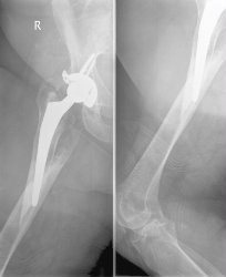 Heuprevisie totale heupprothese - De Heupkliniek Oudenaarde (Vlaamse ...