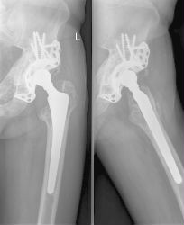 Heuprevisie totale heupprothese - De Heupkliniek Oudenaarde (Vlaamse ...