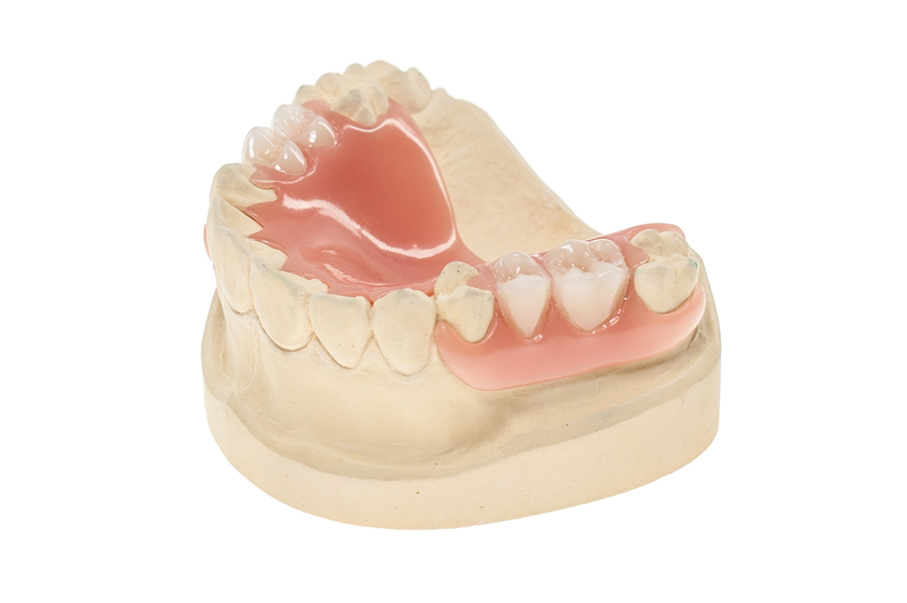 Flexiprothese - Premium sensitive - Metallfreier Zahnersatz