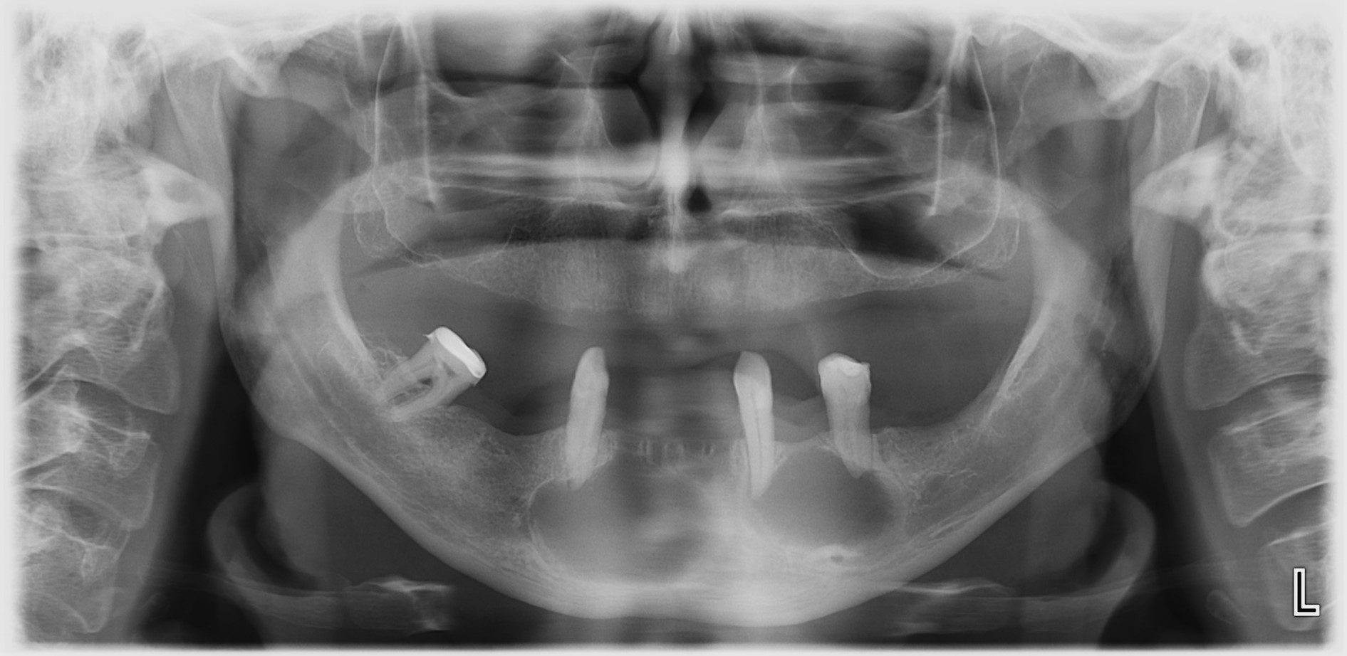 Caso No 622: Lesión Radiolúcida en Maxilar Inferior. - CDI