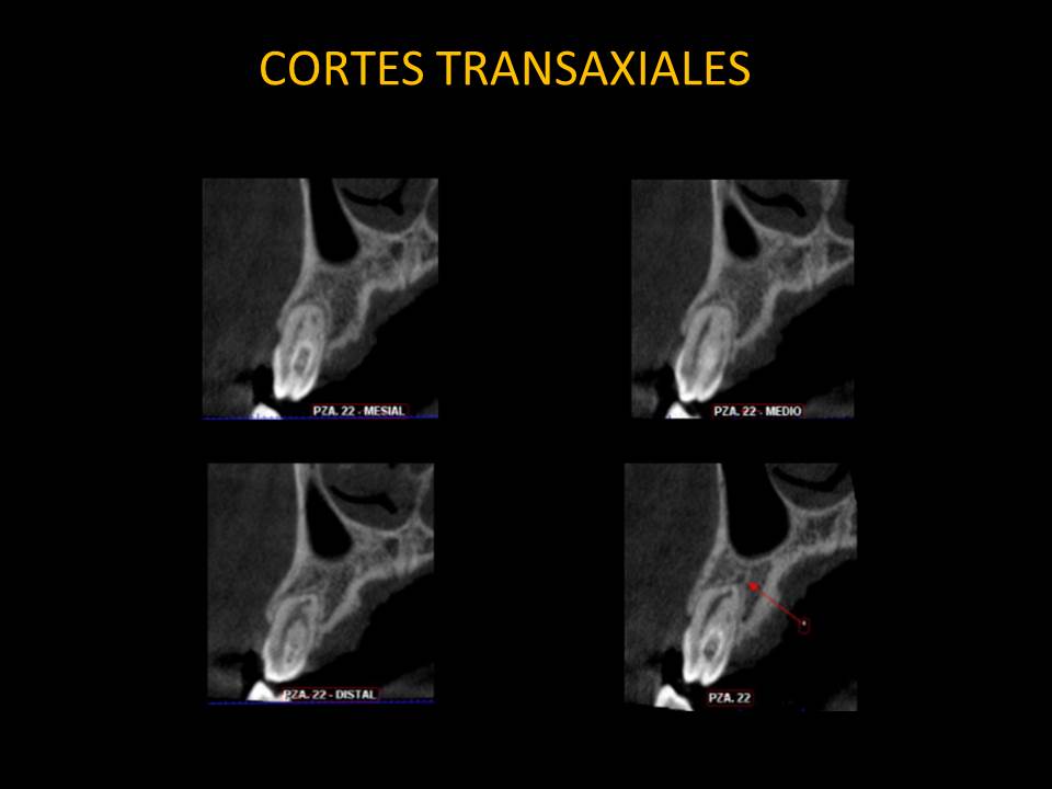Caso N°580: Dens Invaginatus - CDI