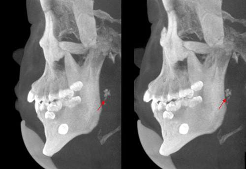 Caso 301 - TONSILOLITOS (Evaluación con tomografía volumétrica) - CDI