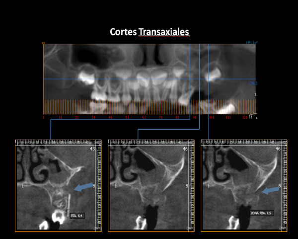 Caso 446 - TRAUMATISMO MANDIBULAR CON FRACTURA SUBCONDILAR BILATERAL - CDI