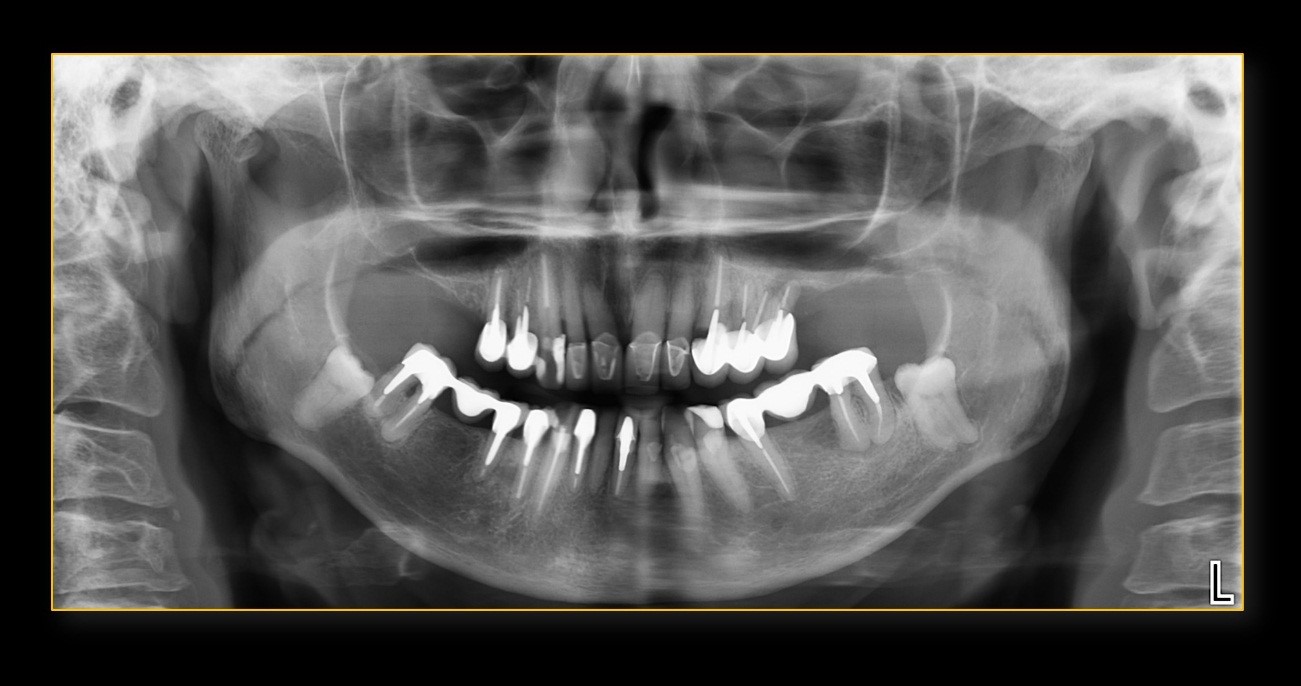 Caso Nº604: Fractura Radicular - CDI