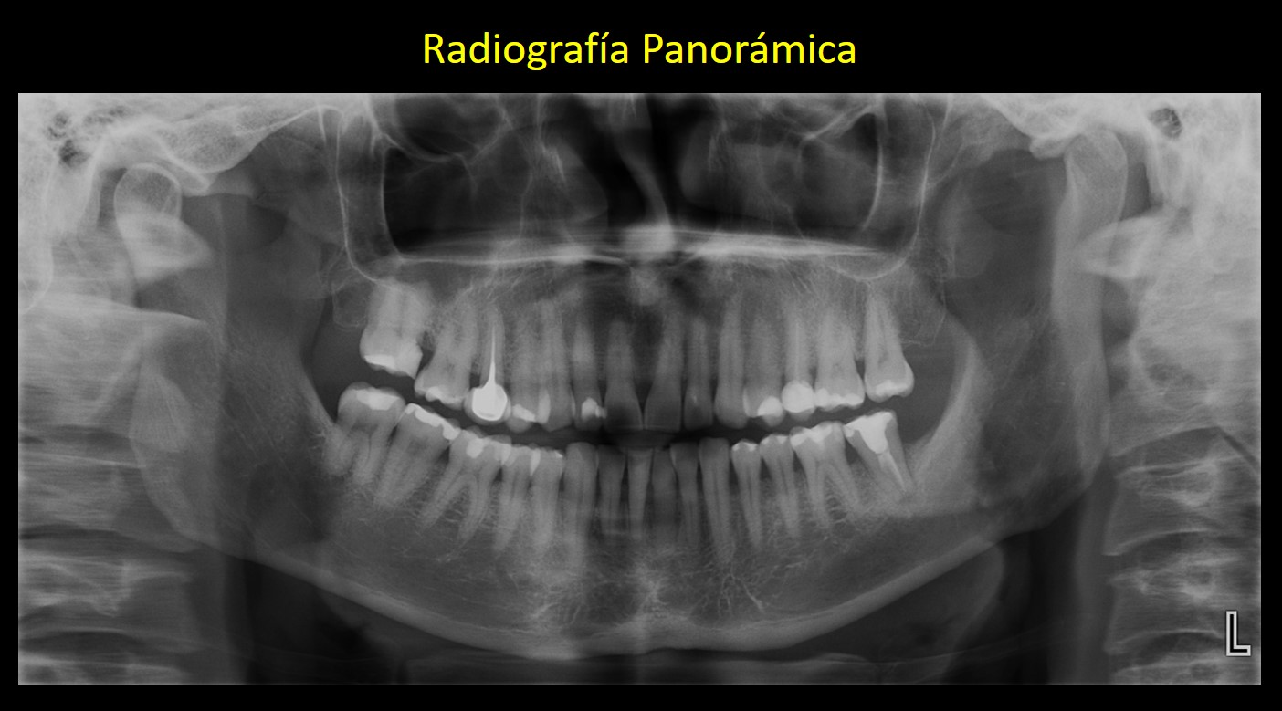 Caso N° 583: Conducto Radicular en forma de "C" - CDI