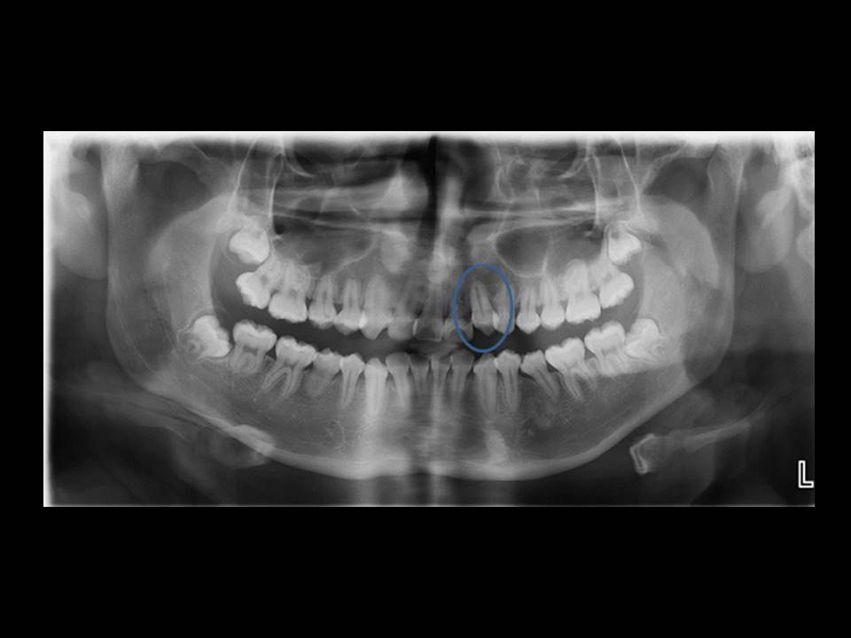 Caso N°580: Dens Invaginatus - CDI