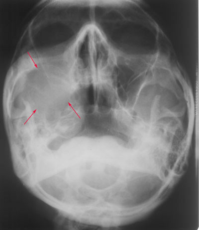 Caso 74 - CARCINOMA DEL MAXILAR - CDI