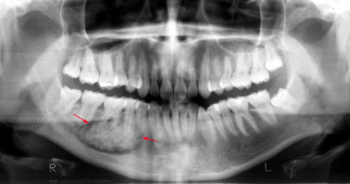 Caso 96 - CEMENTOBLASTOMA VERDADERO BENIGNO - CDI
