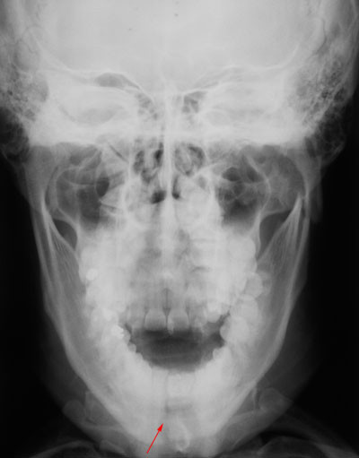 Caso 218 - FRACTURA MANDIBULAR - CDI