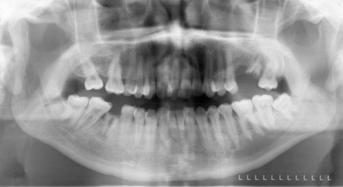 Caso 100 - GEMINACIÓN DENTARIA - CDI