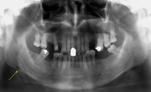 Caso 4 - Defecto óseo de Stafne (Cavidad ósea de Stafne) - CDI