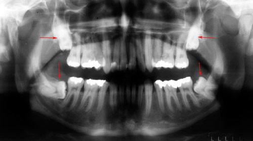 Caso 55 - TERCEROS MOLARES IMPACTADOS - CDI