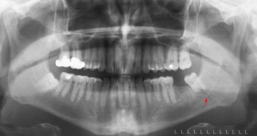 Caso 213 - FRACTURA MANDIBULAR - CDI